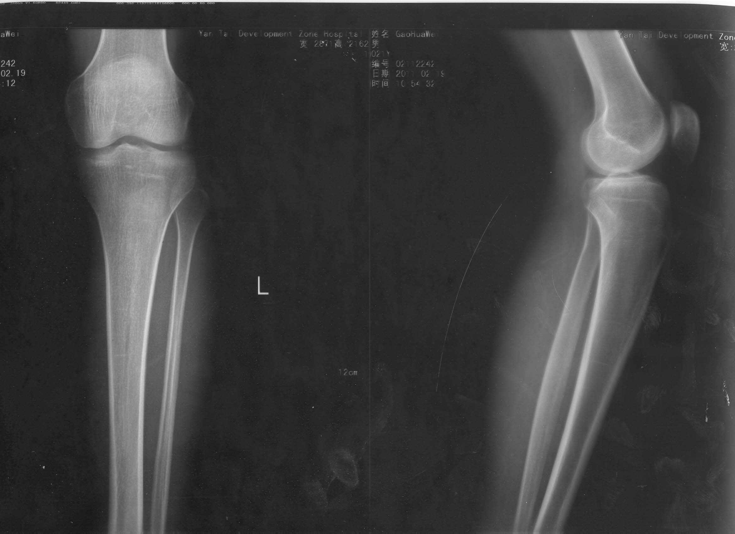 32cm * 43cm Xray Paper Medical Laser Imaging Film For KND-DRYTEC-4000 KND-K