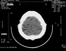 8 x 10 Scratch-resistant Medical Paper Xray Films For Konida Laser Printers
