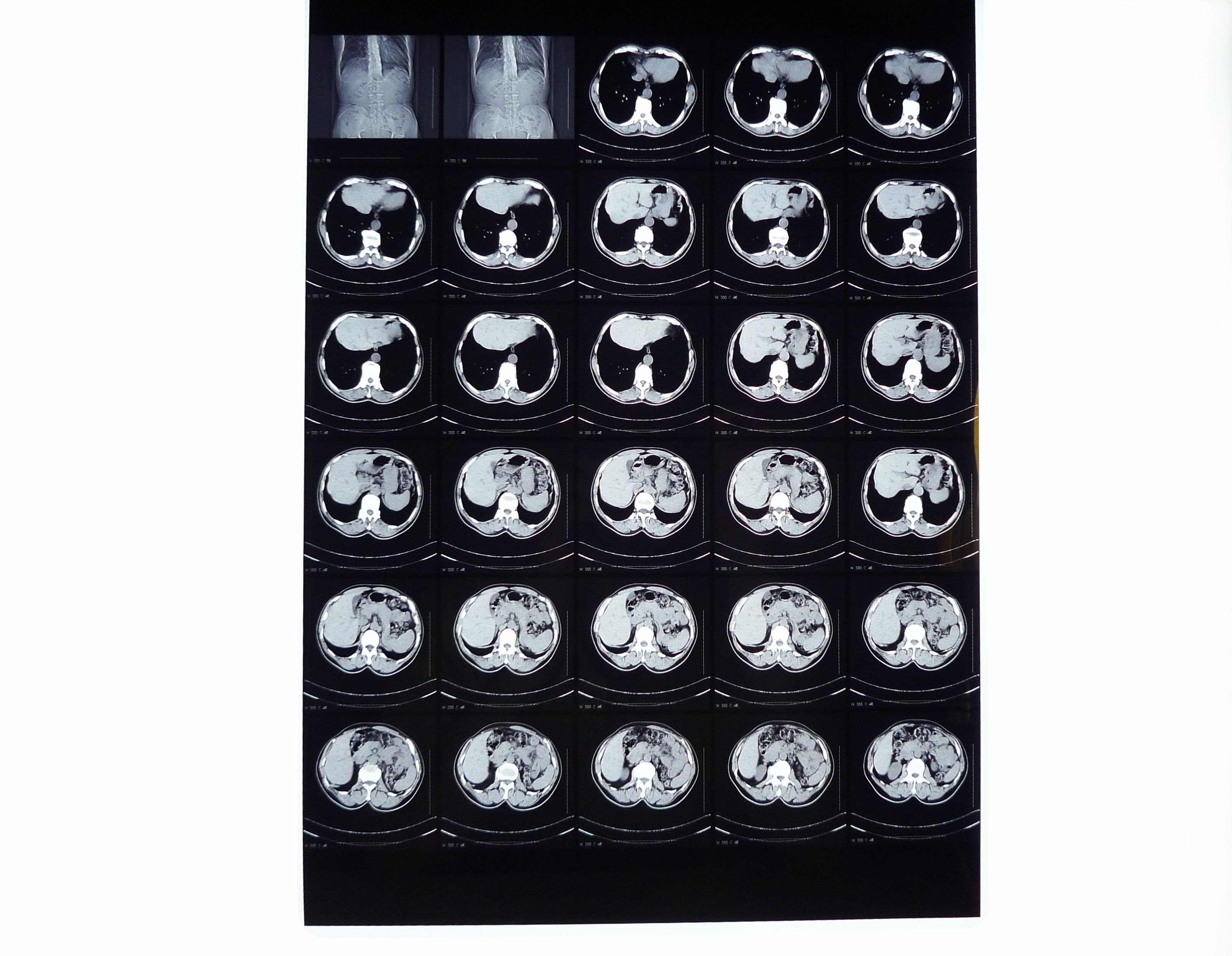 8in x 10in High Density Medical Dry Film For Fuji DRYPIX 3000 / 2000 ...